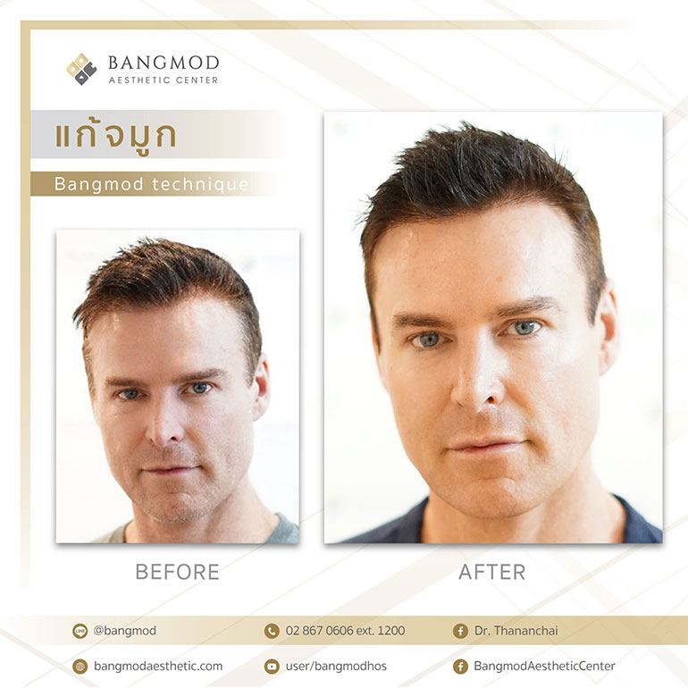 รีวิว Mr. Simon Farrow ดารา Hollywood ศัลยกรรมแก้ทรงจมูก